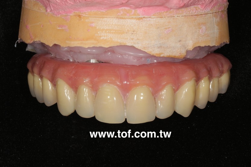 All-on-4: Let smile arc….smile! - 全口重建醫師的部落格 All-on-4 Blog